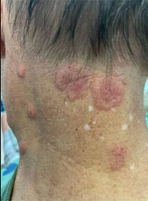 Persistent Painful Rash in a 63-Year-Old Man