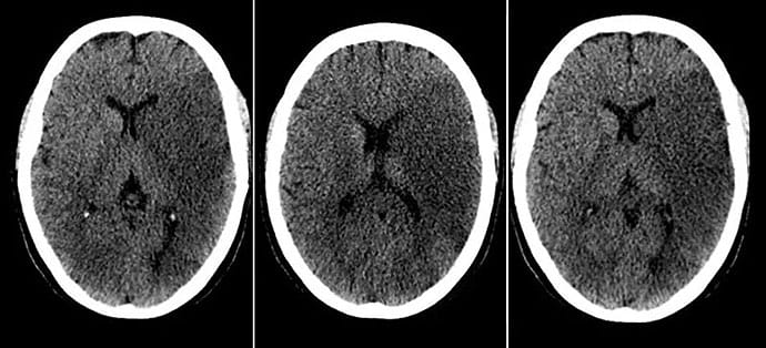 Sudden-Onset Weakness in a Woman With Iron Deficiency Anemia