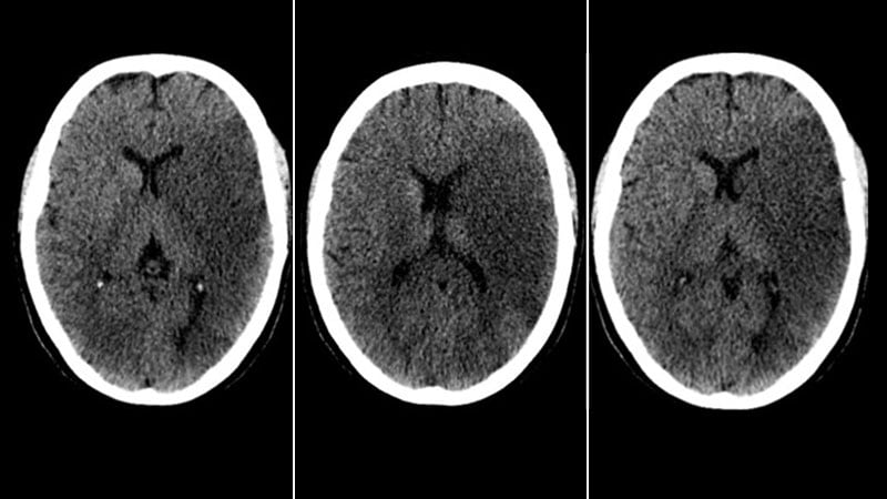 Sudden-Onset Weakness in a Woman With Iron Deficiency Anemia