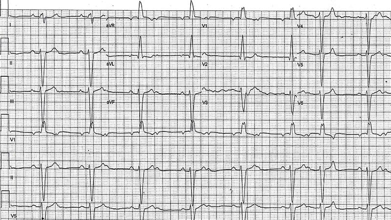 ECG Challenge: Worsening Episodes of Chest Pain