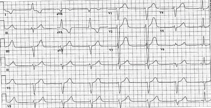 ECG Challenge: Heart Rhythms After Angioplasty and Stenting