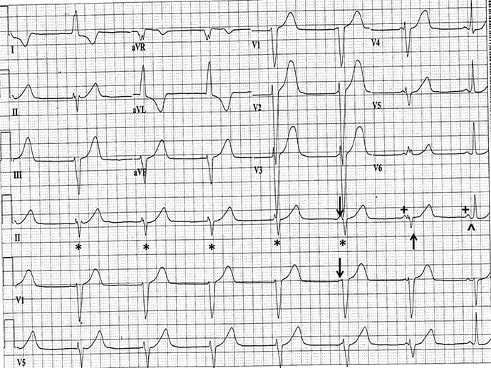 ECG Challenge: Heart Rhythms After Angioplasty and Stenting