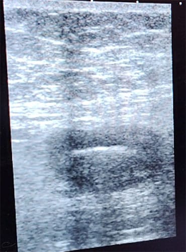 Vomiting and Rectal Bleeding in a 64-Year-Old Woman