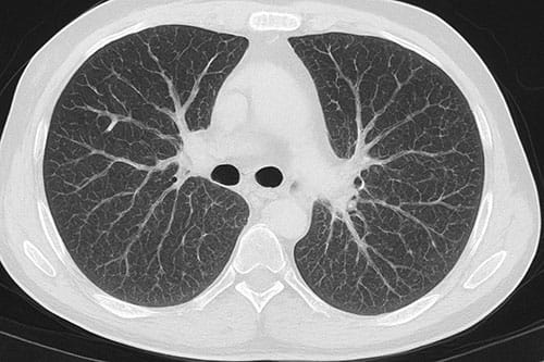 A Nonsmoker With a Persistent Stubborn Cough
