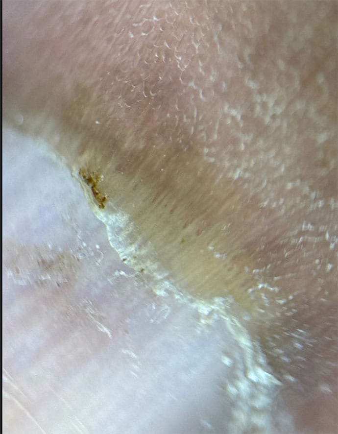 Digital Ulcers With Violaceous Rash in a Middle-Aged Man