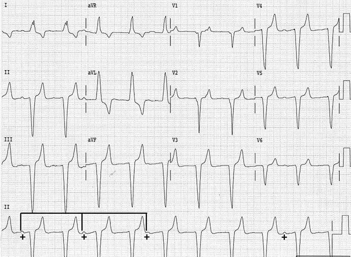 ECG Challenge: Arrhythmia After Stenting