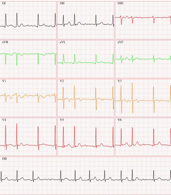 Age 40: Stressed Coffee Drinker Has Acute-Onset Palpitations