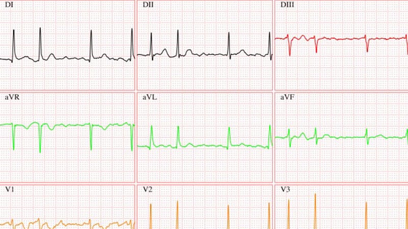 Age 40: Stressed Coffee Drinker Has Acute-Onset Palpitations
