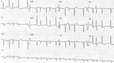 pulse irregularly regular