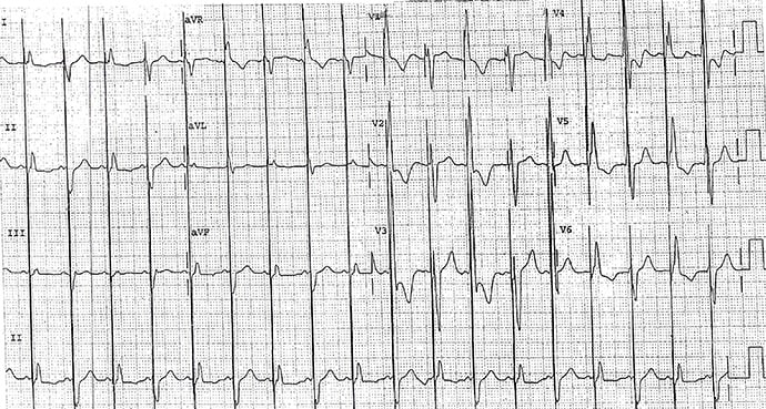ECG Challenge: New Beats With a Pacemaker