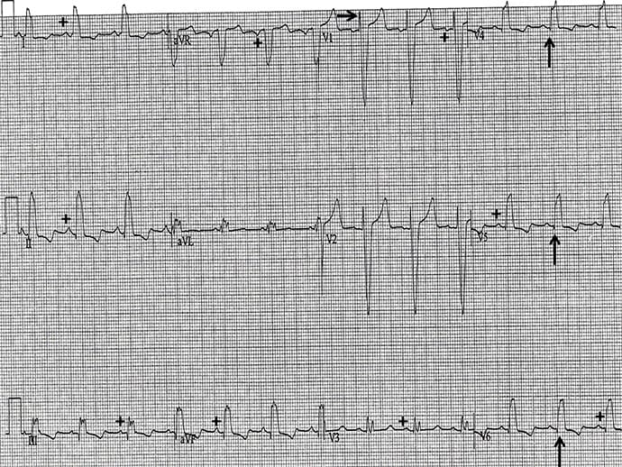 ECG Challenge: Crackling Lung Sounds and Edema