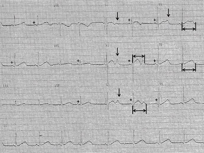 ECG Challenge: Does This Pattern Run in the Family?