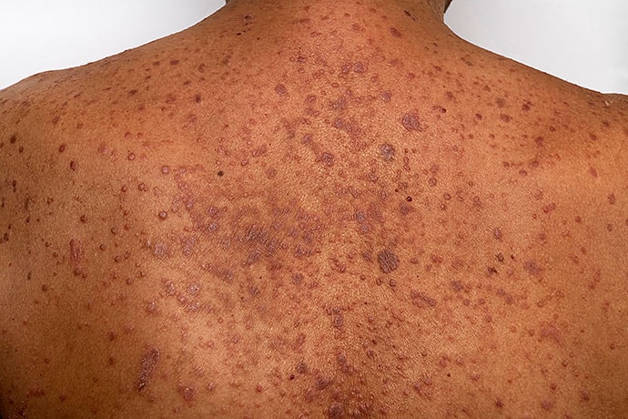 Papular Rash on the Trunk