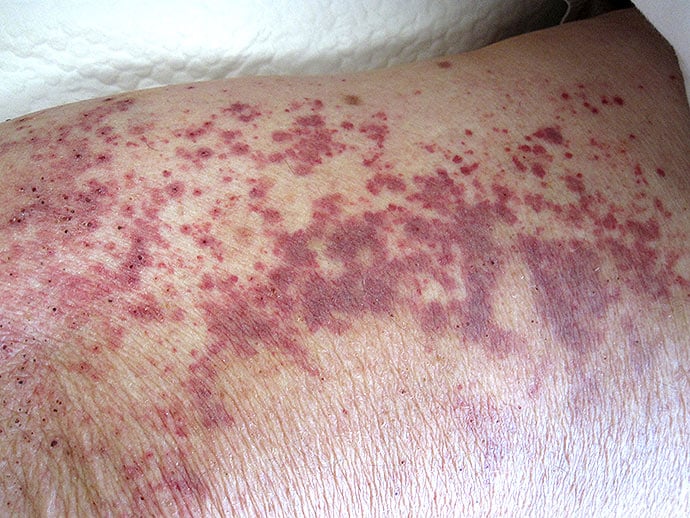 Diffuse Rash, Vomiting, and Confusion in a 30-Year-Old