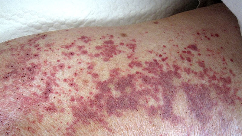 Diffuse Rash, Vomiting, and Confusion in a 30-Year-Old