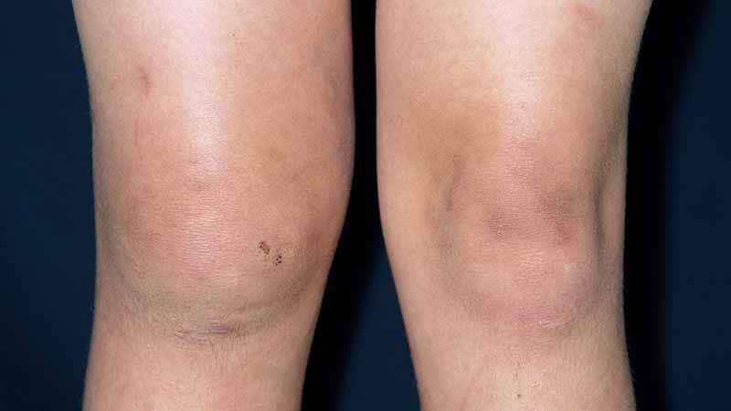 Boy With Nagging Knee Pain