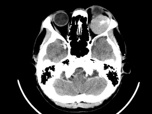 A 51-Year-Old Woman With a Bulging Eye and Diplopia