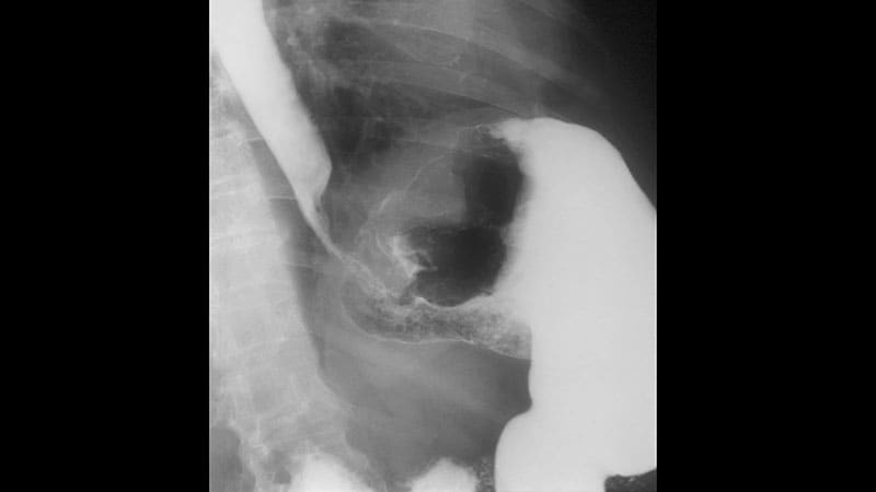 ASTRO Issues First Guideline on Gastric Cancer Radiotherapy