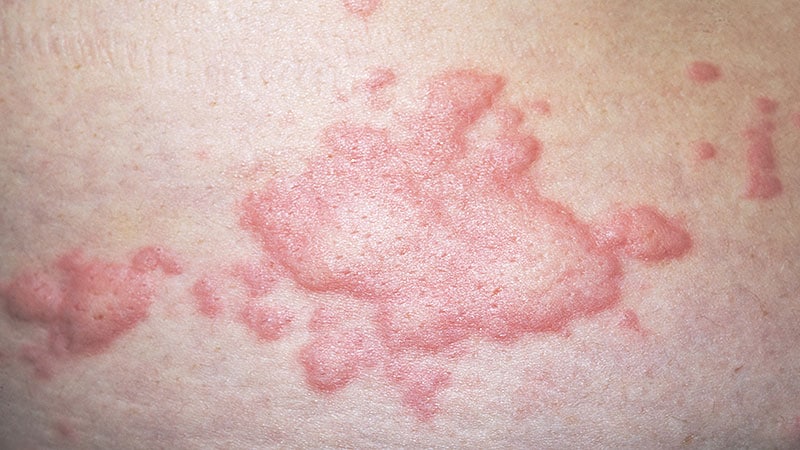 Full-Body Rash, Dyspnea, and Swelling in a 16-Year-Old Girl