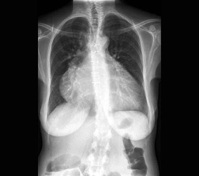 An 85-Year-Old Woman with Nausea and Vomiting