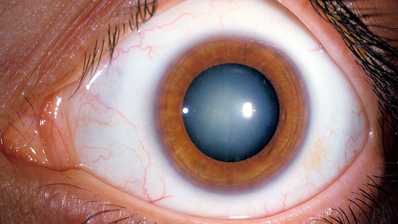 No Complications With First Human Robotic Cataract Surgery