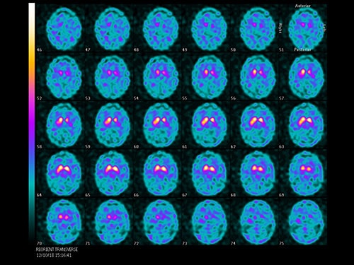 Functional Decline After Early Retirement