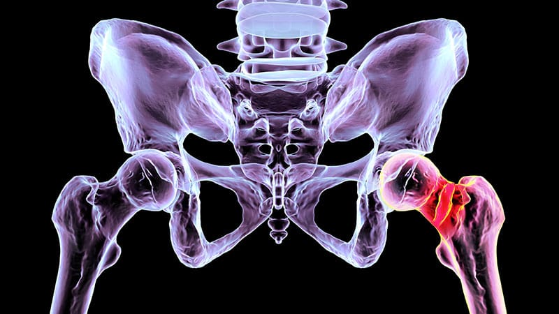 Fast Five Quiz: Fracture Prevention in Osteoporosis