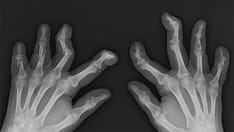 Guselkumab Adds PsA Structural Damage Inhibition to Label