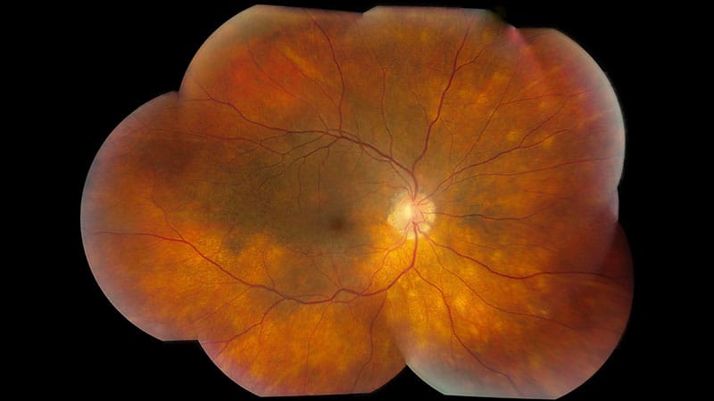 Families Traveling for Uveitis Screenings Face Higher Costs