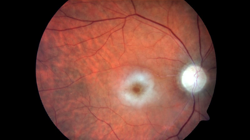 AMD and Retinal Disease | Medscape