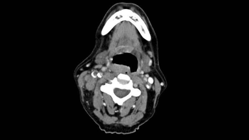 Proton Therapy Improves Outcomes in Oropharyngeal Cancer