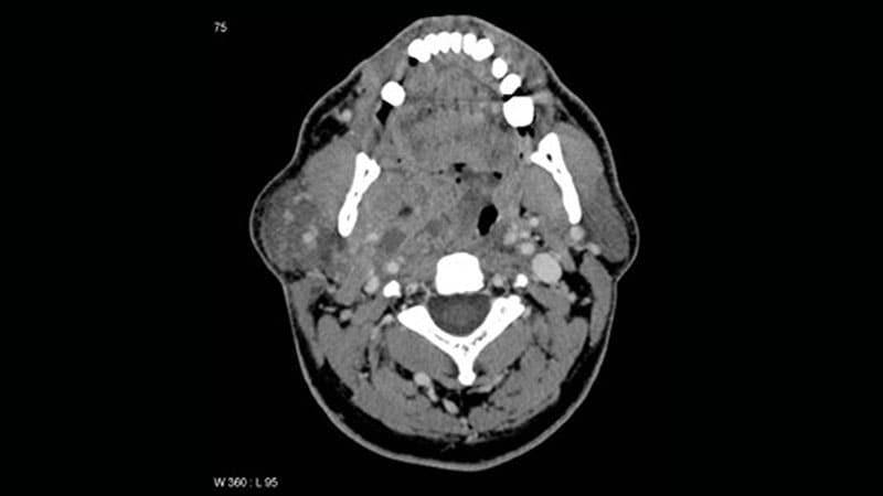 Man With Dyspnea, Neck Swelling, and Dysphagia