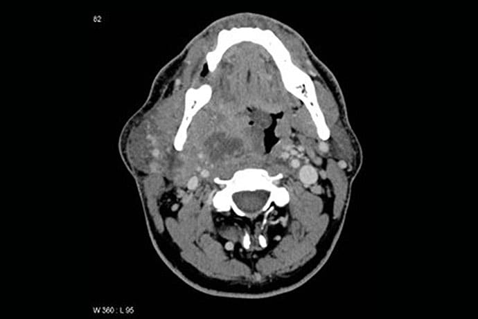 Linee guida NICE - Tosse acuta, prescrizione di antimicrobici