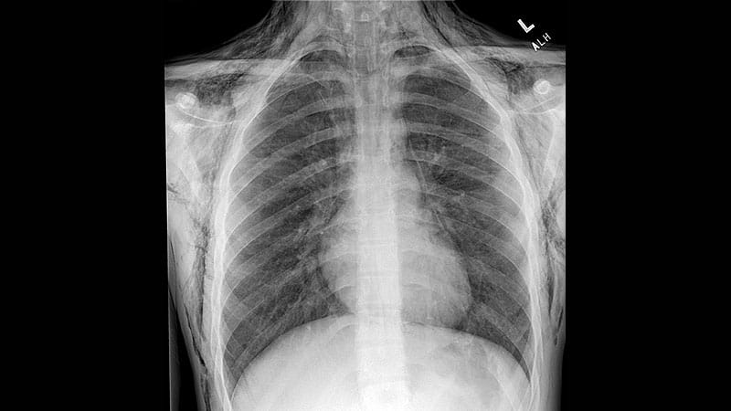 S3-Leitlinie Sepsis: Was ist neu?