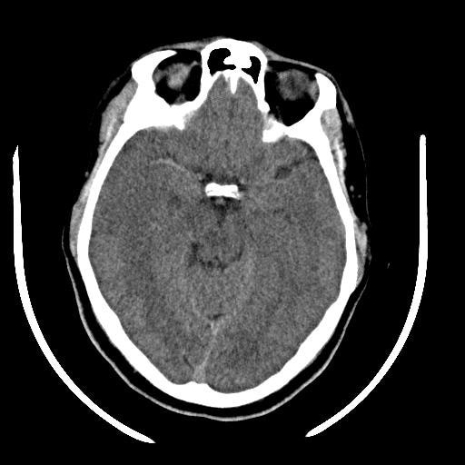 Man With a Violent Cough Develops Ptosis and Slurred Speech