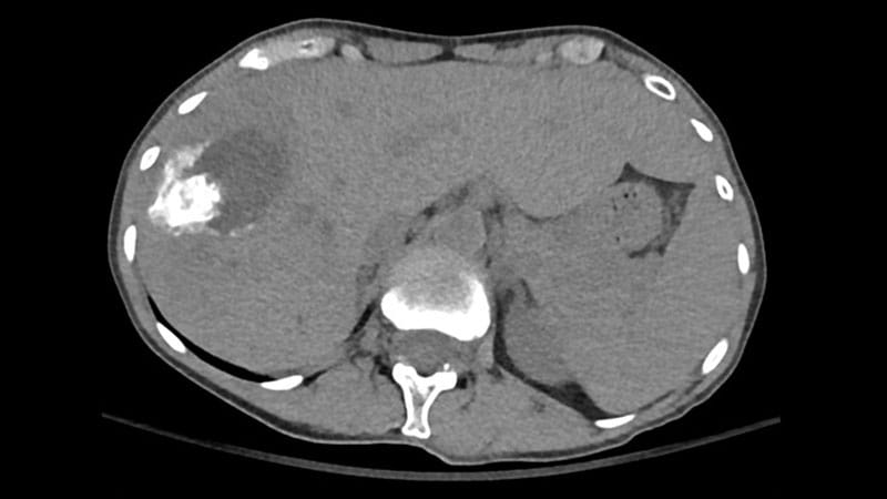 Sudden Abdominal Pain After a Bear Hug in a Teen