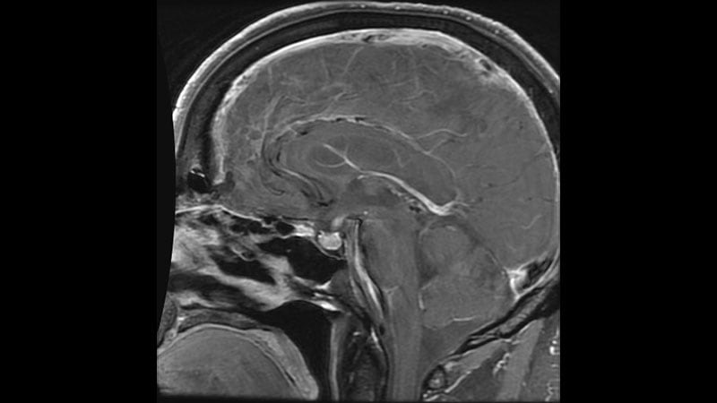 Falls and Fatigue in a Woman With Breast Cancer
