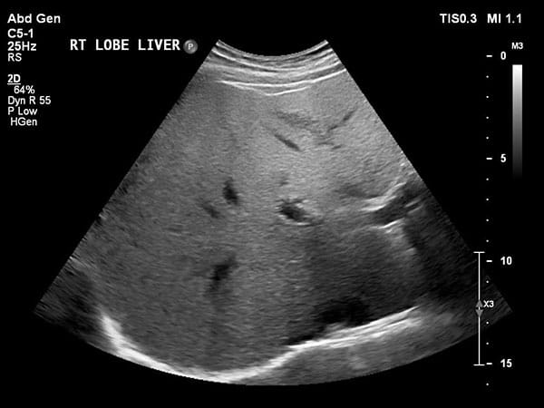 Pleuritic RUQ Pain in a 25-Year-Old Woman
