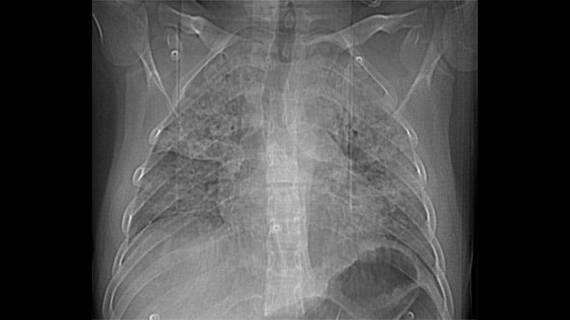 Hypothermic, Unresponsive Woman Brought to the Hospital