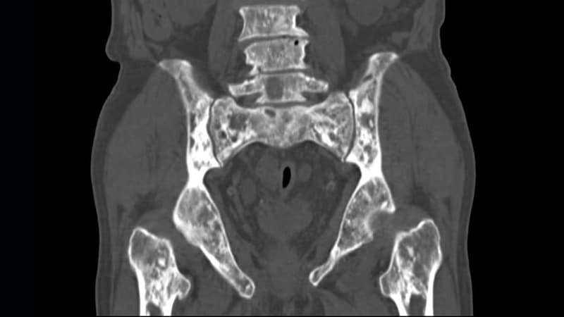 Ovarian Cancer | Medscape