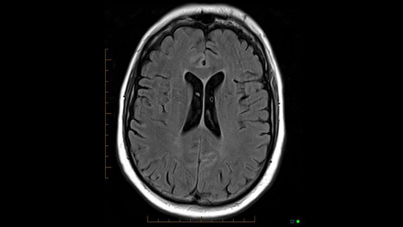 Proton CSI: New Standard of Care for Leptomeningeal Metastases? | Frank ...