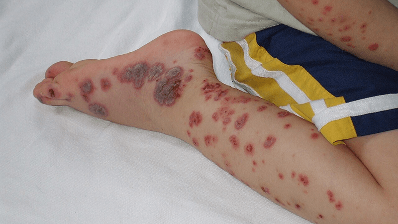 Severe Skin Symptoms in IgA Vasculitis Linked to Relapse