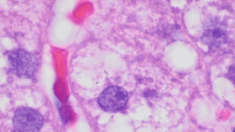 Pemvidutide Shows Liver and Cardiovascular Benefits in MASH