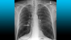 When Alcohol and COPD Collide, Lungs Suffer More