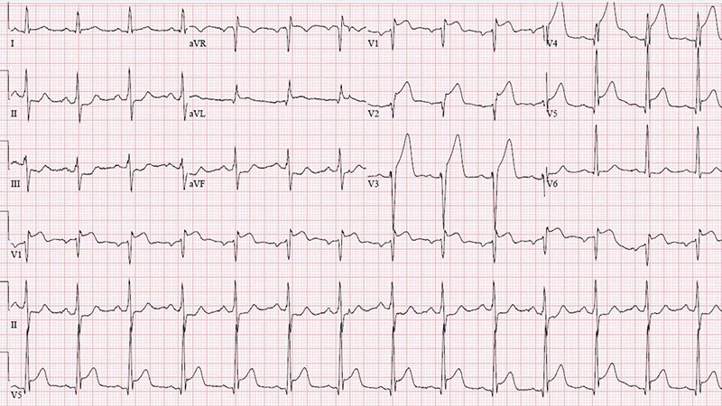 Stroke/Cerebrovascular Disease | Medscape