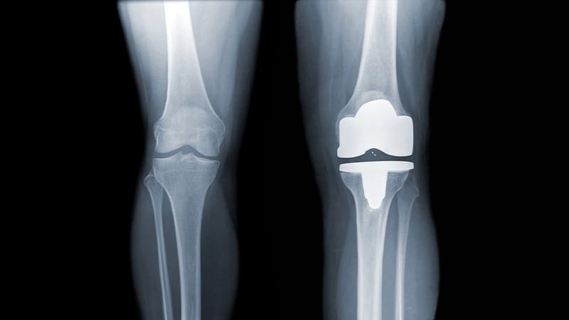 Should Knee Replacement Move Beyond One Size Fits All?