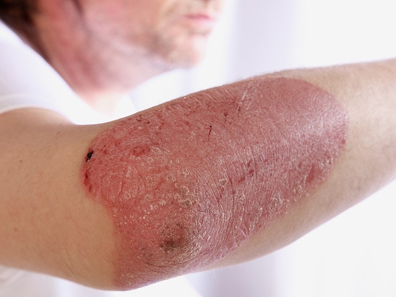 NICE Draft Guidance Recommends Secukinumab for Severe Plaque Psoriasis