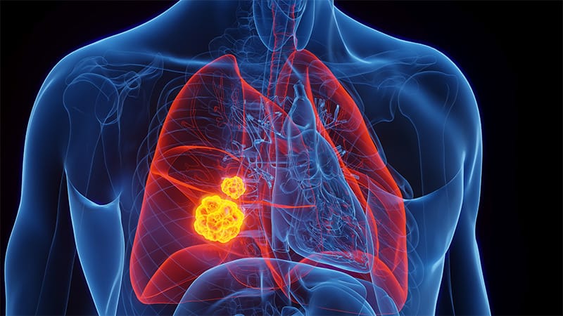 En pratique / Oncologie – La mucite induite par les traitements du cancer