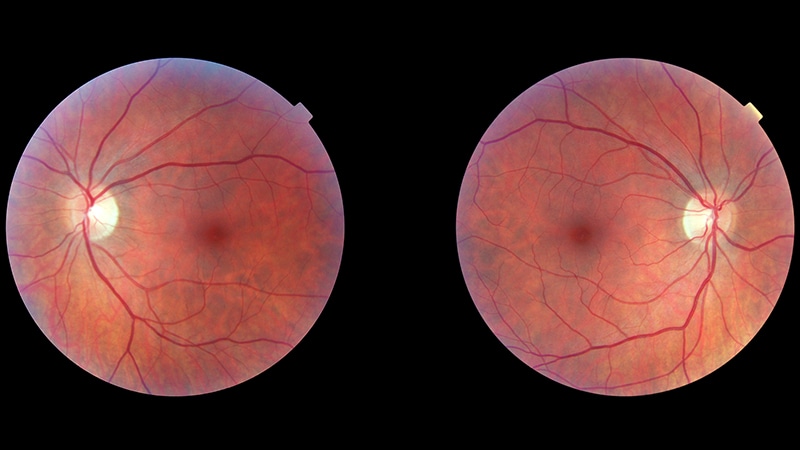 NICE Backs New Injection for Macular Degeneration