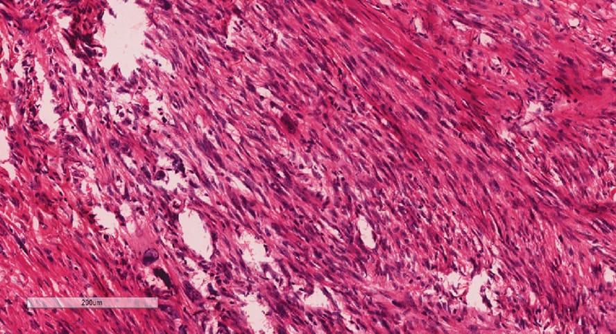 Caso clinico - Un giovane con una misteriosa protuberanza sulla spalla